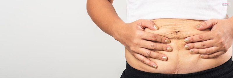 Apron Belly Why It Happens And What You Can Do
